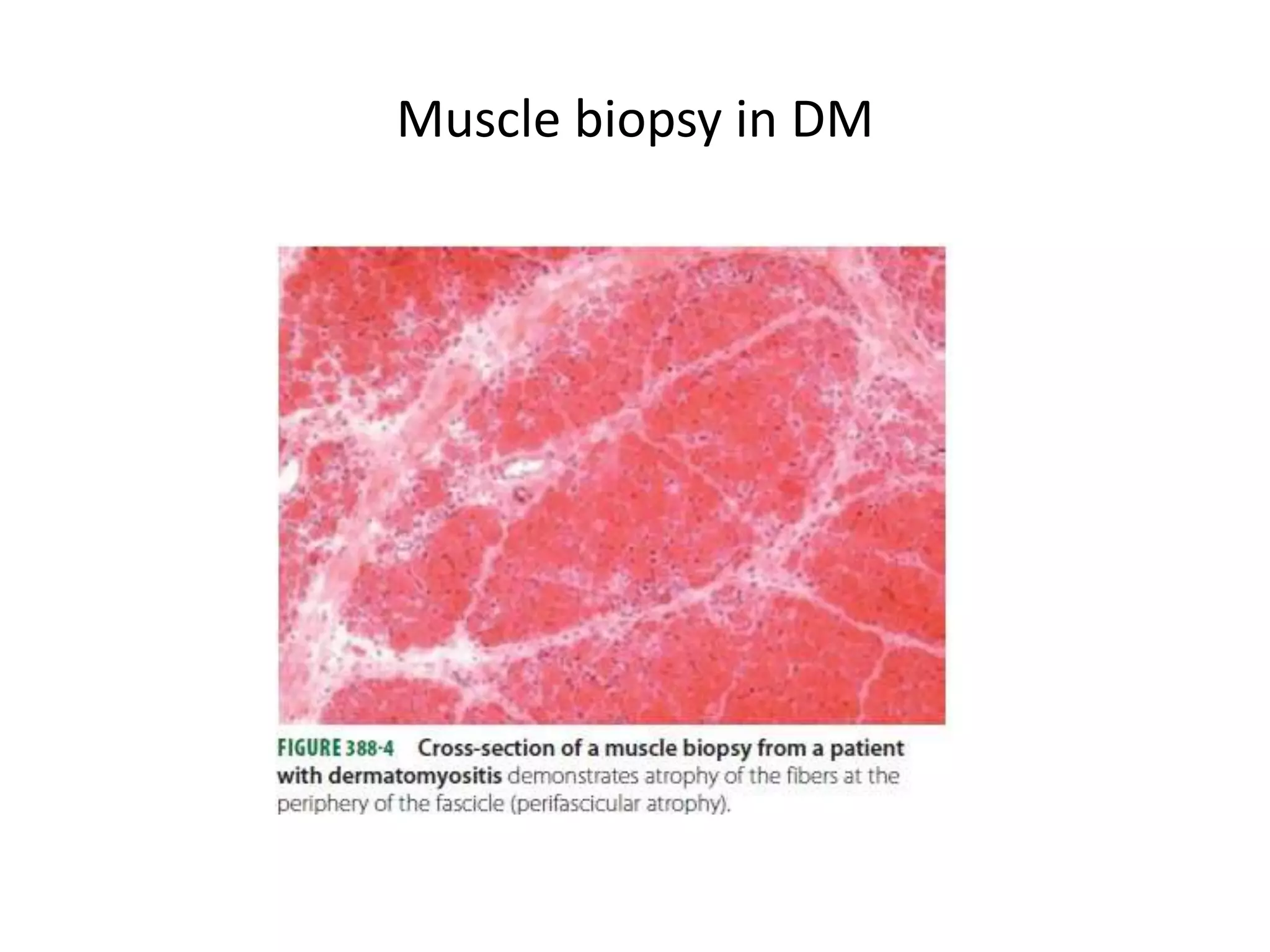 Dermatomyositis | PPTX