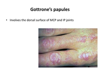 Dermatomyositis | PPTX