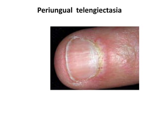 Periungual Erythema