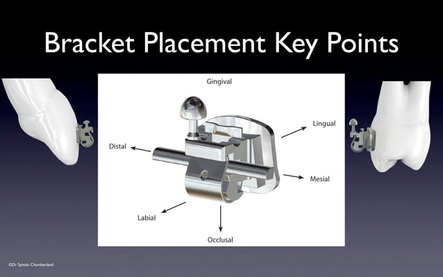 SPEED Bracket Placement Guide v2012 | KEY | Oral care | Personal Care