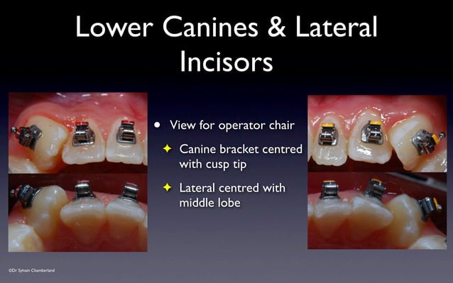 SPEED Bracket Placement Guide v2012 | KEY | Oral care | Personal Care