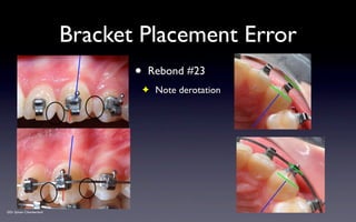 SPEED Bracket Placement Guide v2012 | KEY