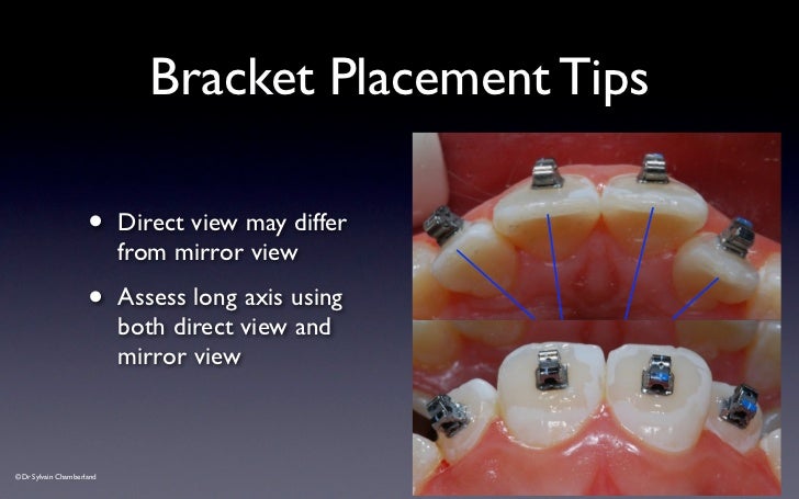 SPEED Bracket Placement Guide v2012