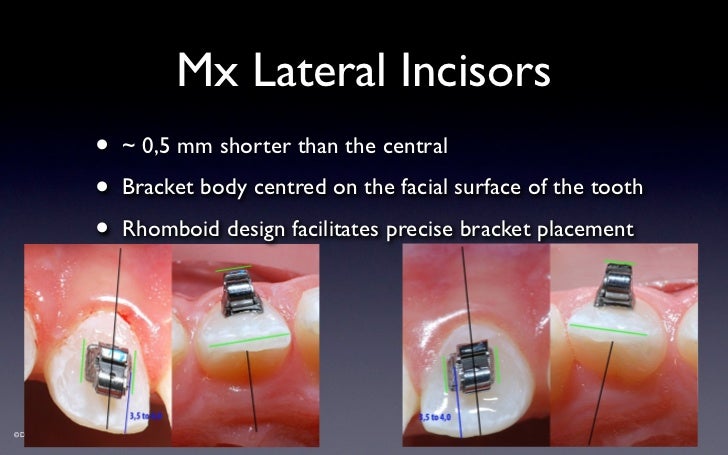 SPEED Bracket Placement Guide v2012