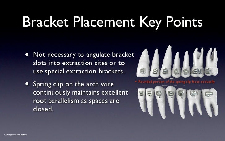 SPEED Bracket Placement Guide v2012