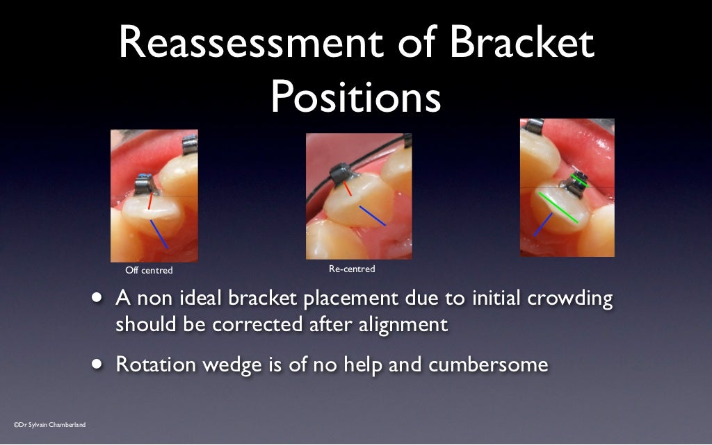 SPEED Bracket Placement Guide v2012