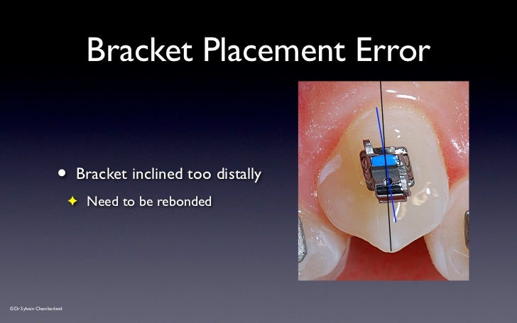 SPEED Bracket Placement Guide v2012