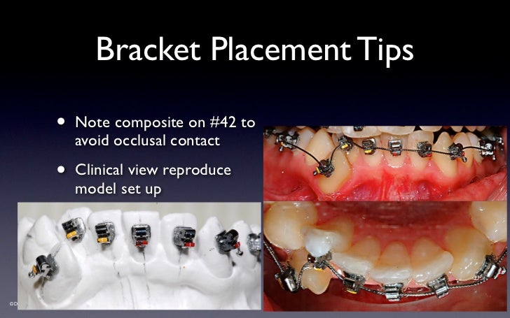 SPEED Bracket Placement Guide v2012