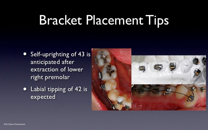 SPEED Bracket Placement Guide v2012