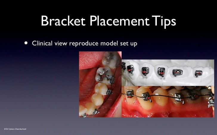 SPEED Bracket Placement Guide v2012