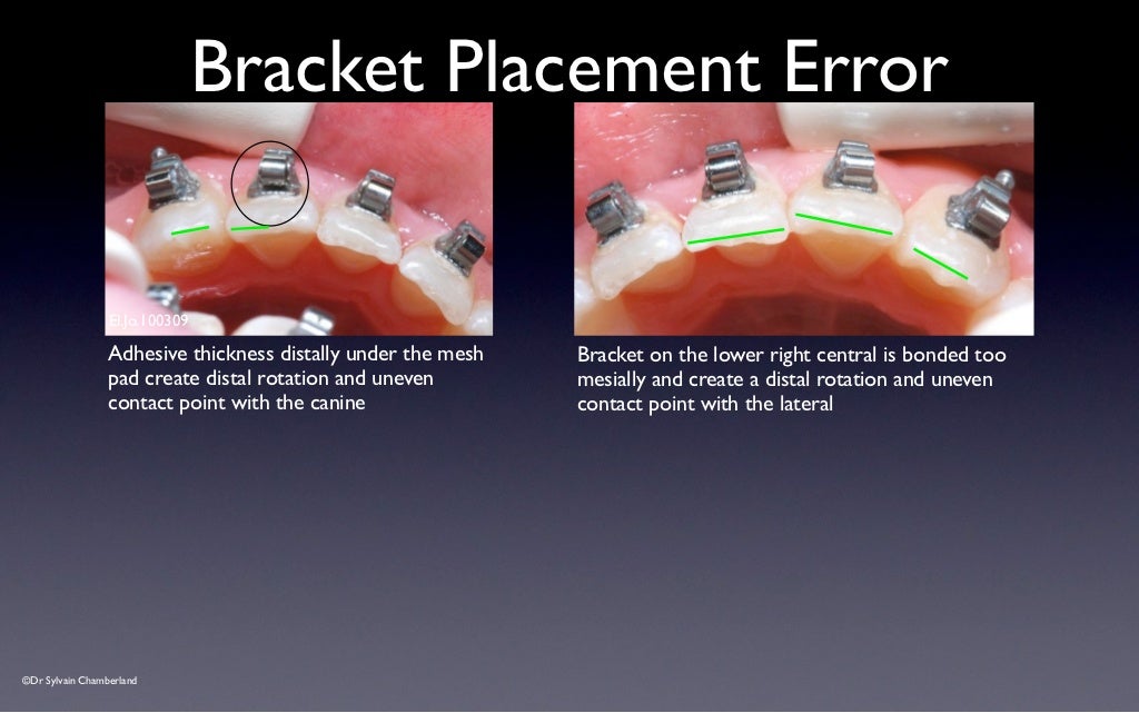 SPEED Bracket Placement Guide v2012