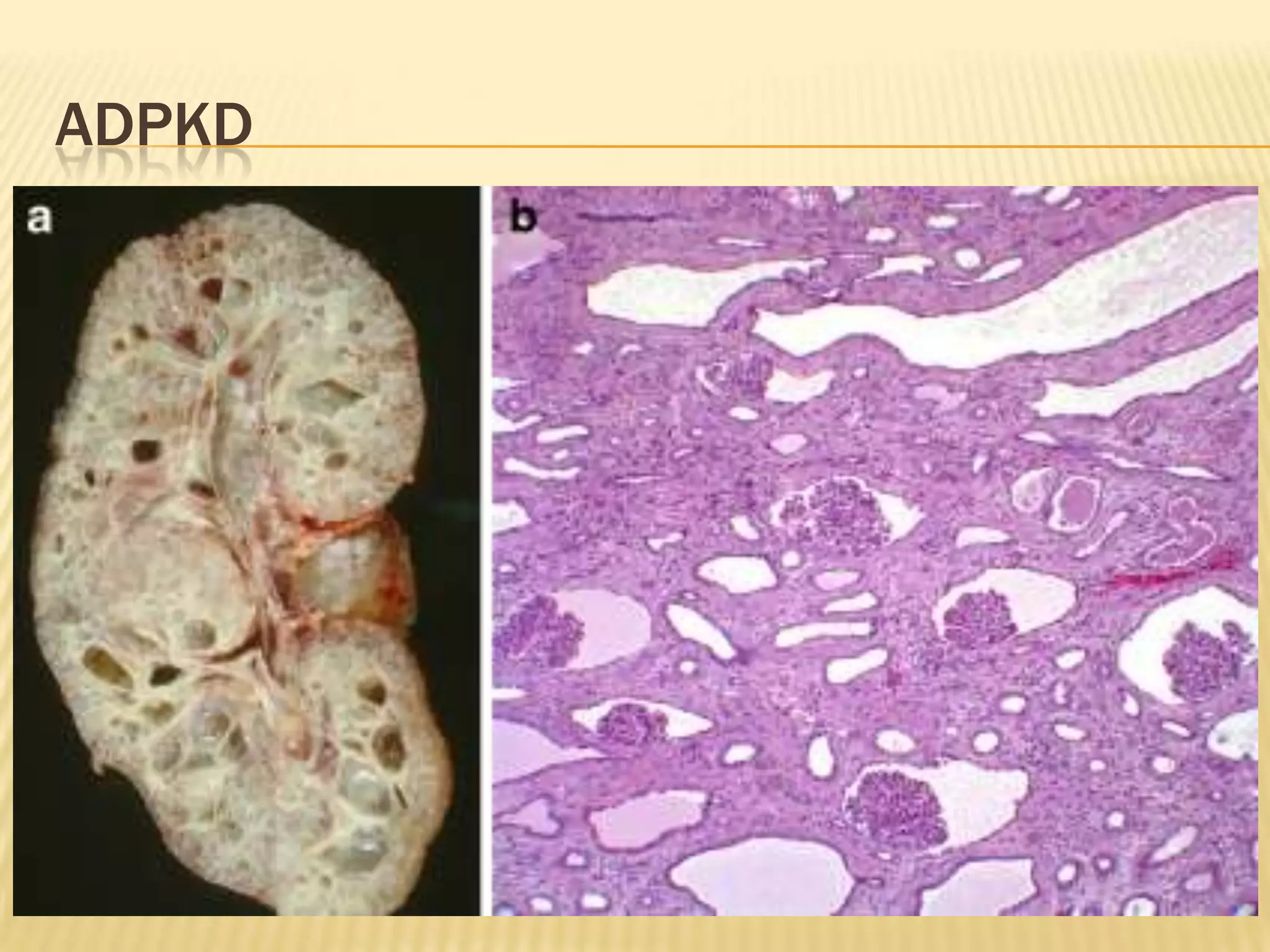 2-1. CAKUT. Svetlana Paunova (eng) | PPTX | Blood Disorders | Diseases ...
