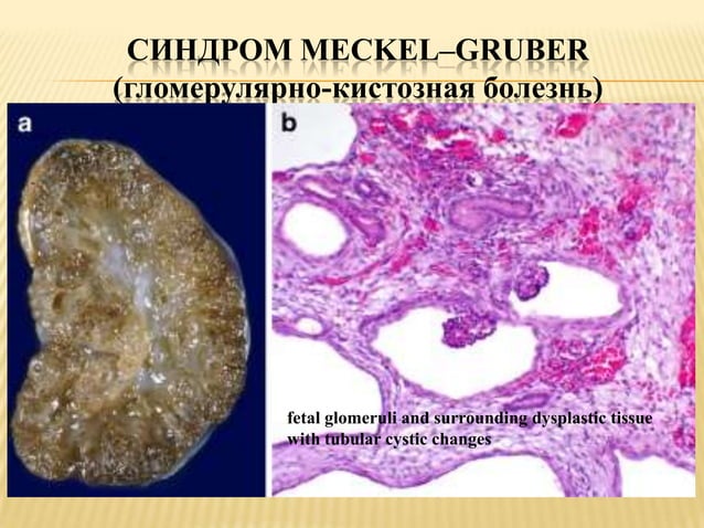2-1. CAKUT. Svetlana Paunova (eng) | PPTX | Blood Disorders | Diseases ...