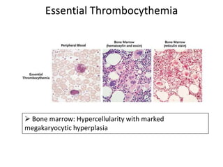 CHRONIC MYELOPROLIFERATIVE NEOPLASMS (MPN)- Primary, 49% OFF