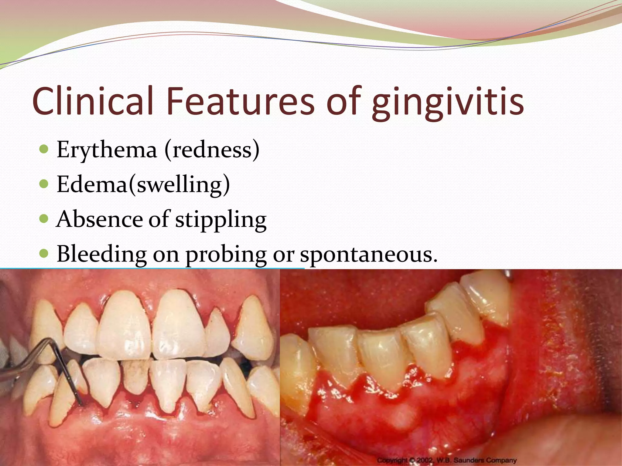 Introduction to Periodontics | PPTX