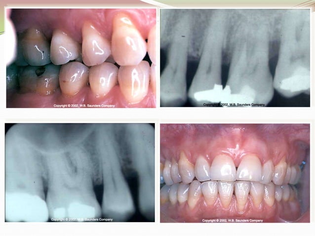 Introduction to Periodontics | PPTX | Dental Health | Diseases and ...