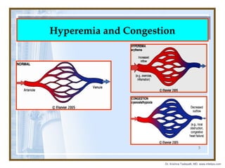2. hyperemia and congestion; hemodynamic disorders | PPT