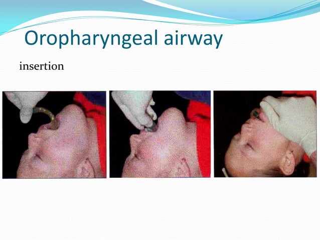 2. airway and breathing management 11 | PDF
