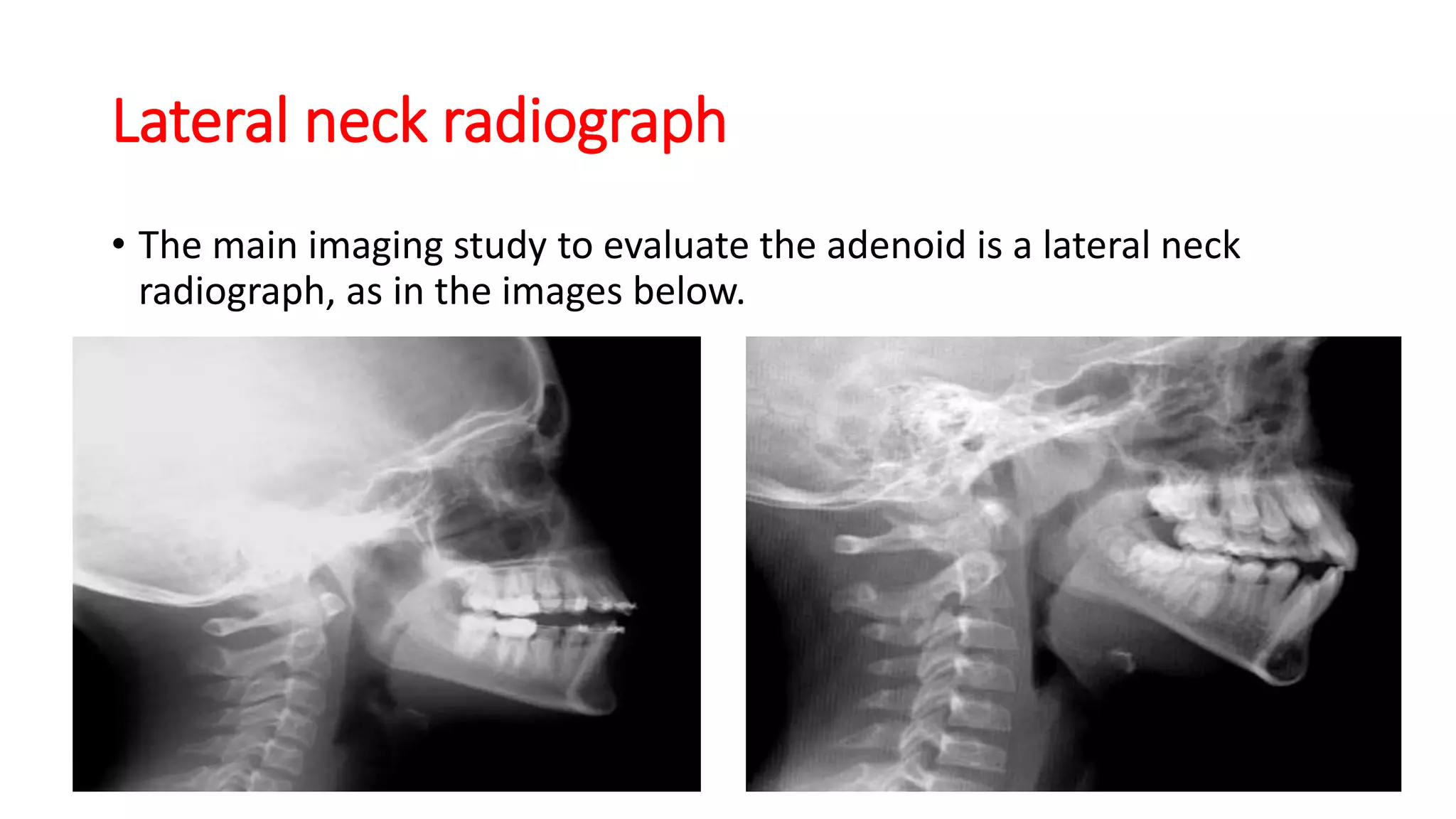 2. adenoid enlargement | PPT
