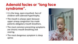 Adenoid Facies Features
