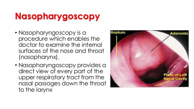 2. adenoid enlargement