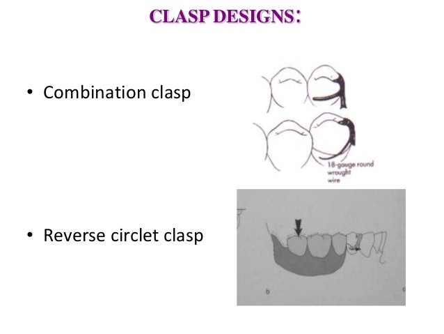 2. principles of designing rpd with special emphsis on support and pe…