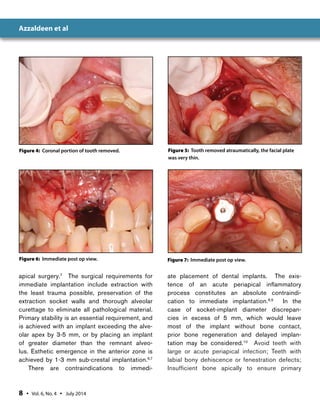 Immediate Implant Placement | PDF