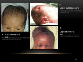 caput, cepahlhematoma & sah | PPTX