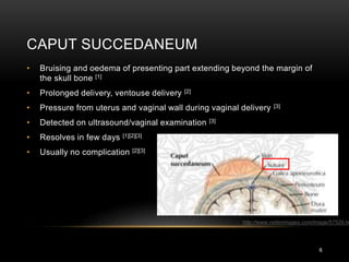 Caput Succedaneum Vs Cephalohematoma