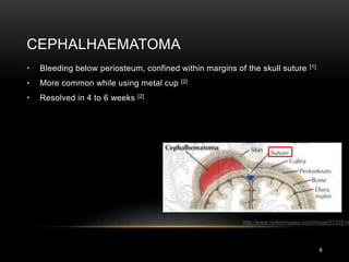 caput, cepahlhematoma & sah | PPTX