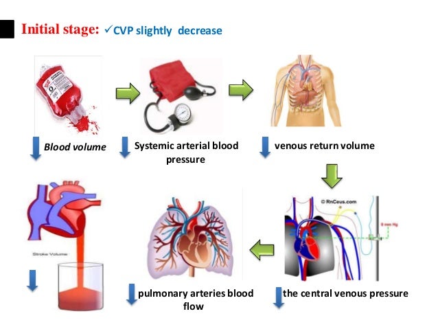 The CVP in hypovolemic shock.