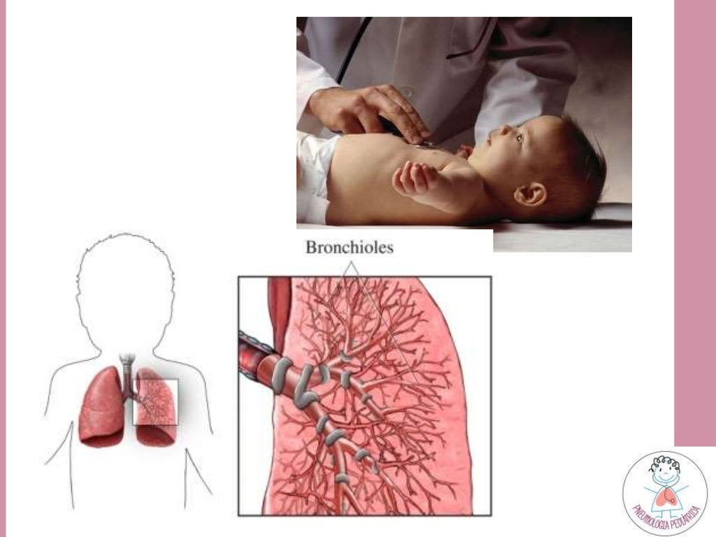 Qual A Diferença De Bronquite E Bronquiolite - Insights e Informações