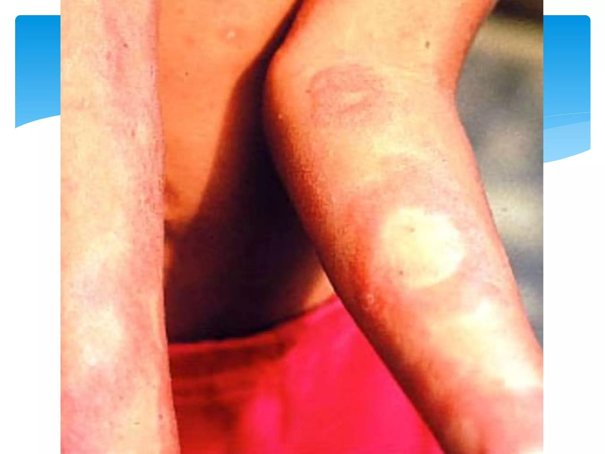 2. mycobacterial infection leprosy- dr. sinhasan, mdzah | PPTX