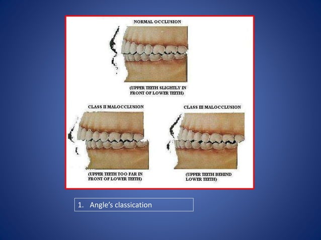 2.occlusion dental vs skeletal | PPTX