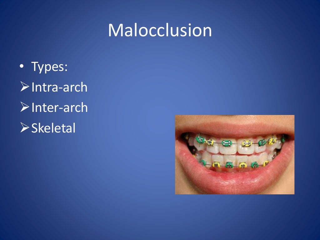 2.occlusion dental vs skeletal