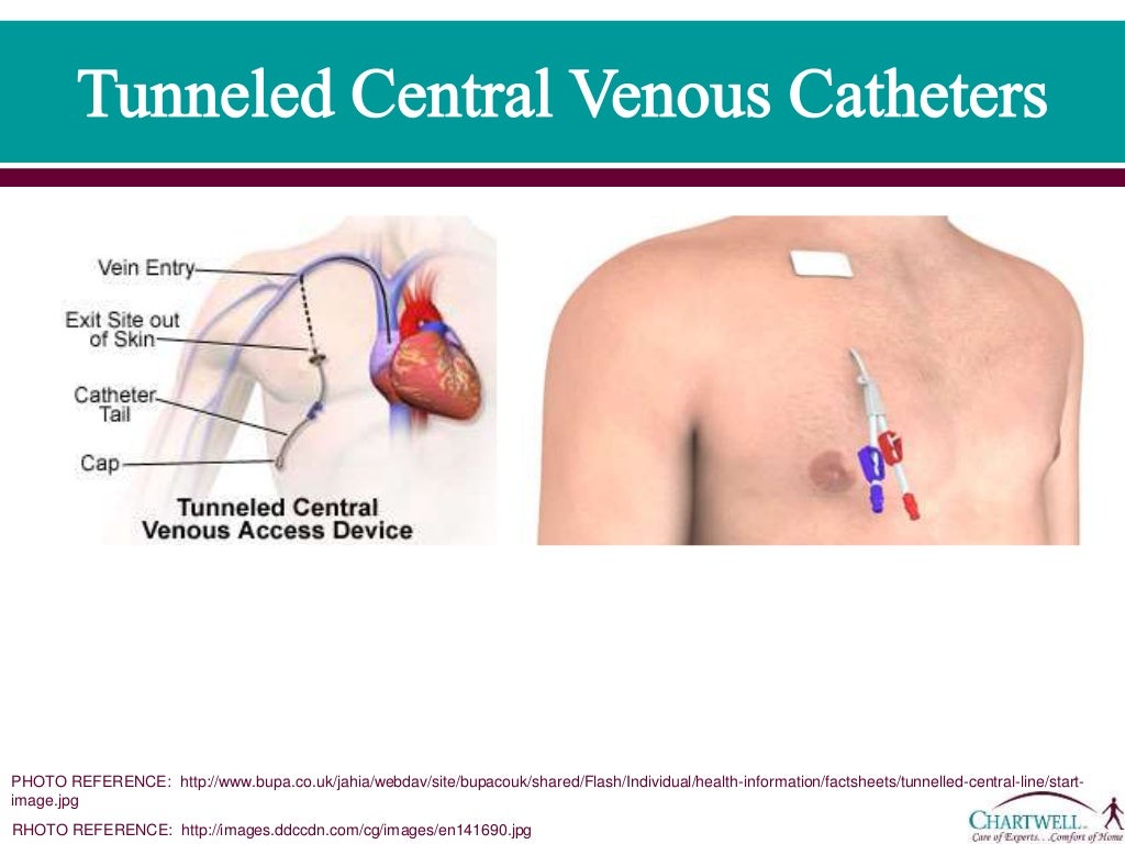 2. central venous access devices (cvads)