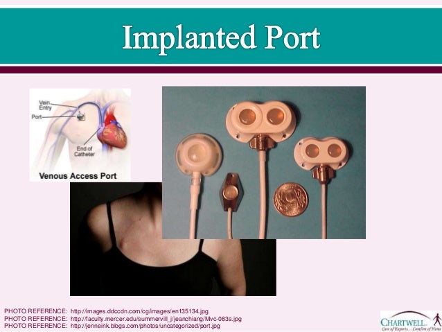 2. central venous access devices (cvads)