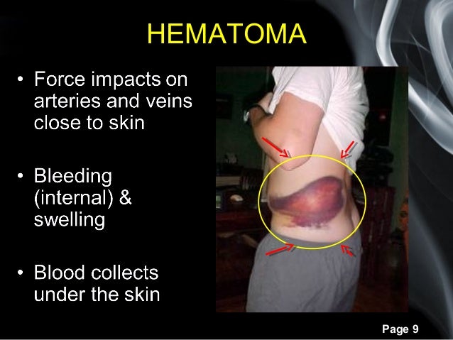 2.2.3 soft tissue injuries