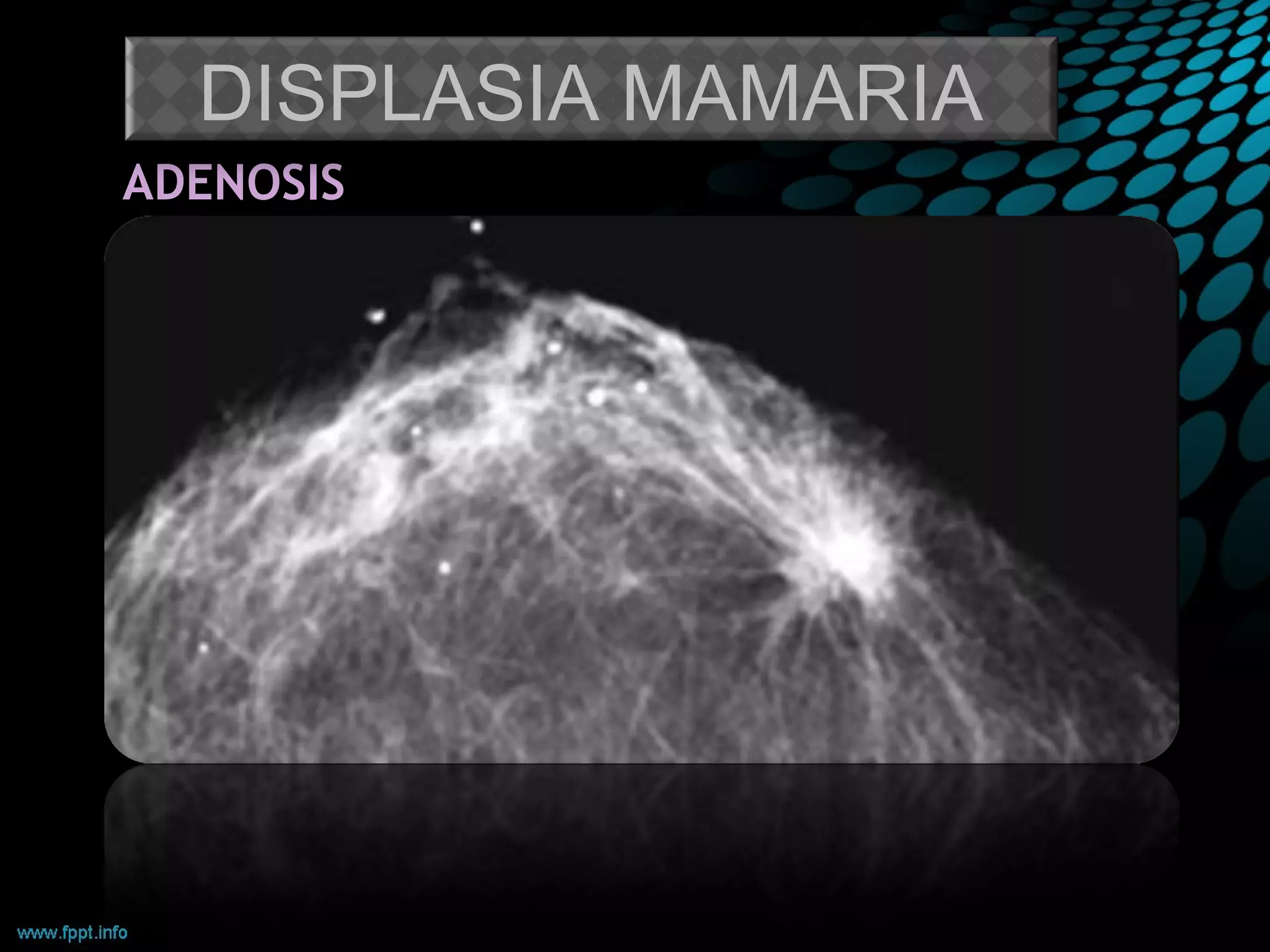 displasia mamaria-lesiones pre malignas de mama | PPT