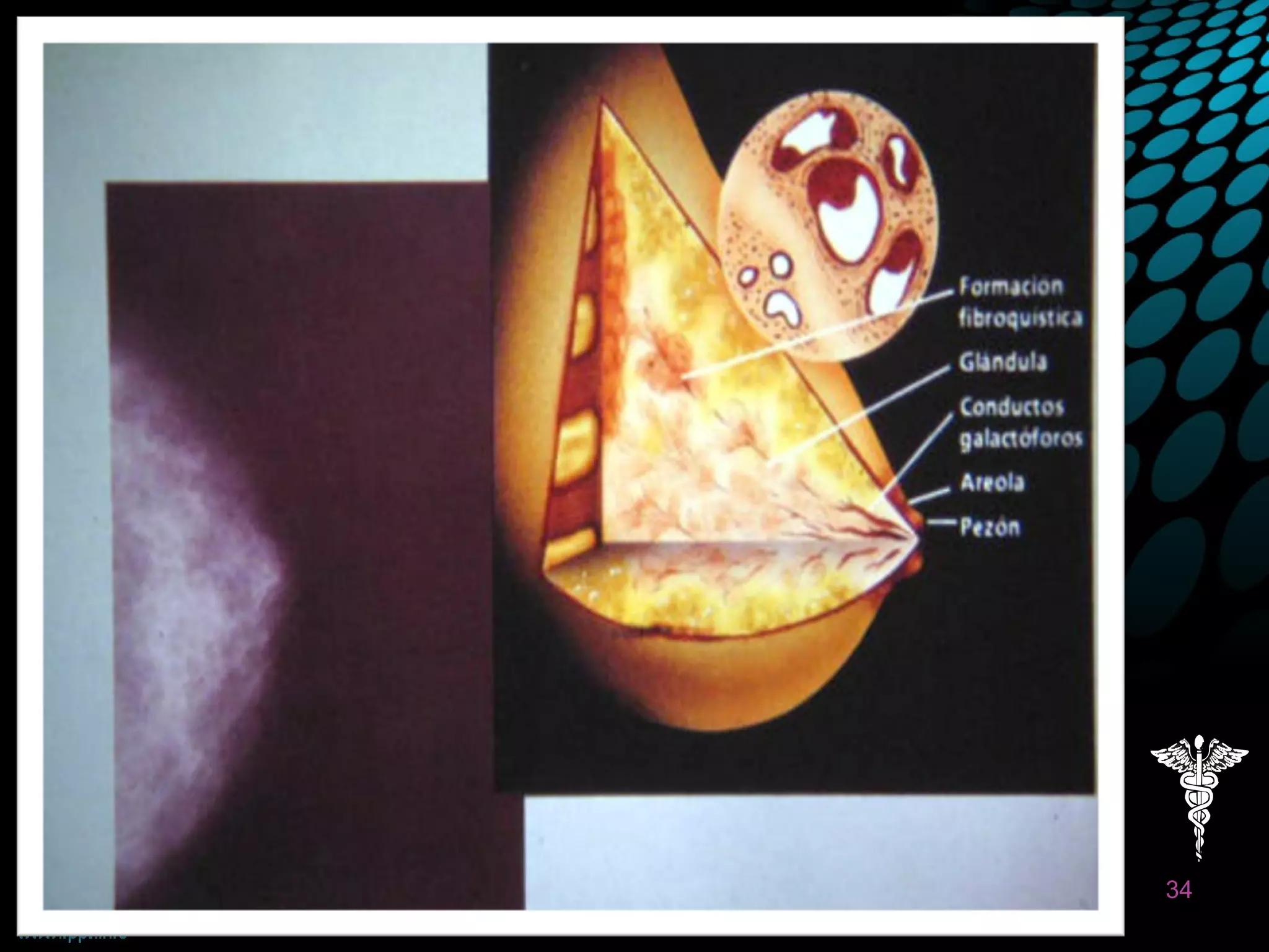 displasia mamaria-lesiones pre malignas de mama | PPT