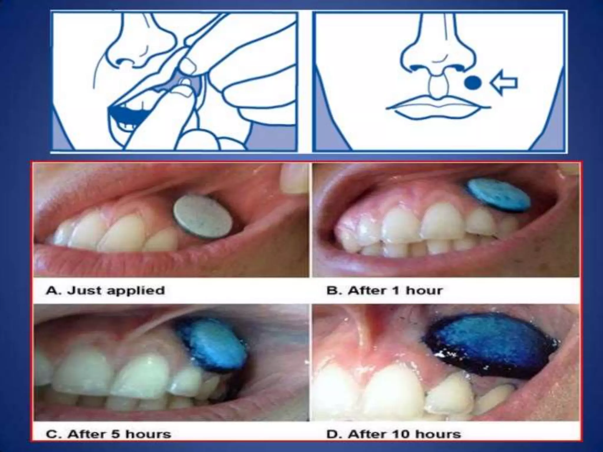 buccal drug delivery system | PPTX
