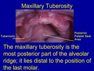 Maxillary Tuberosity Anatomy