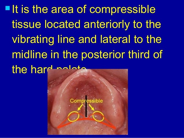 Fovea Palatini Vibrating Line