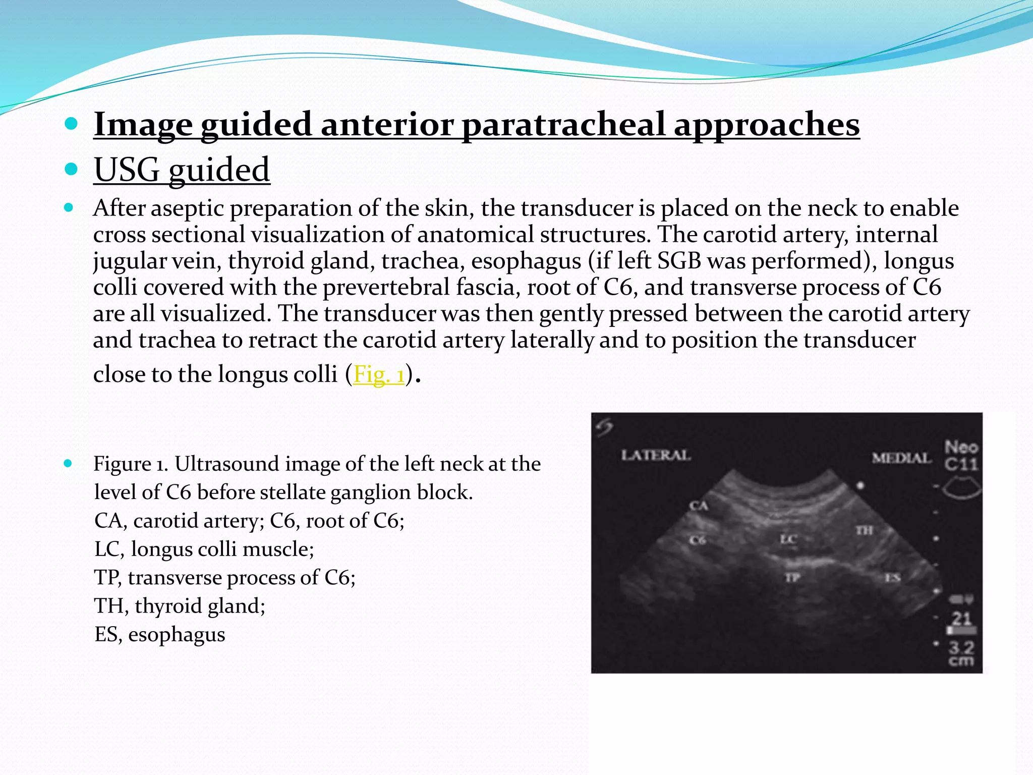 dr. Nur Surya Wirawan - Stellate Ganglion Block ISAPM 2015 | PPTX