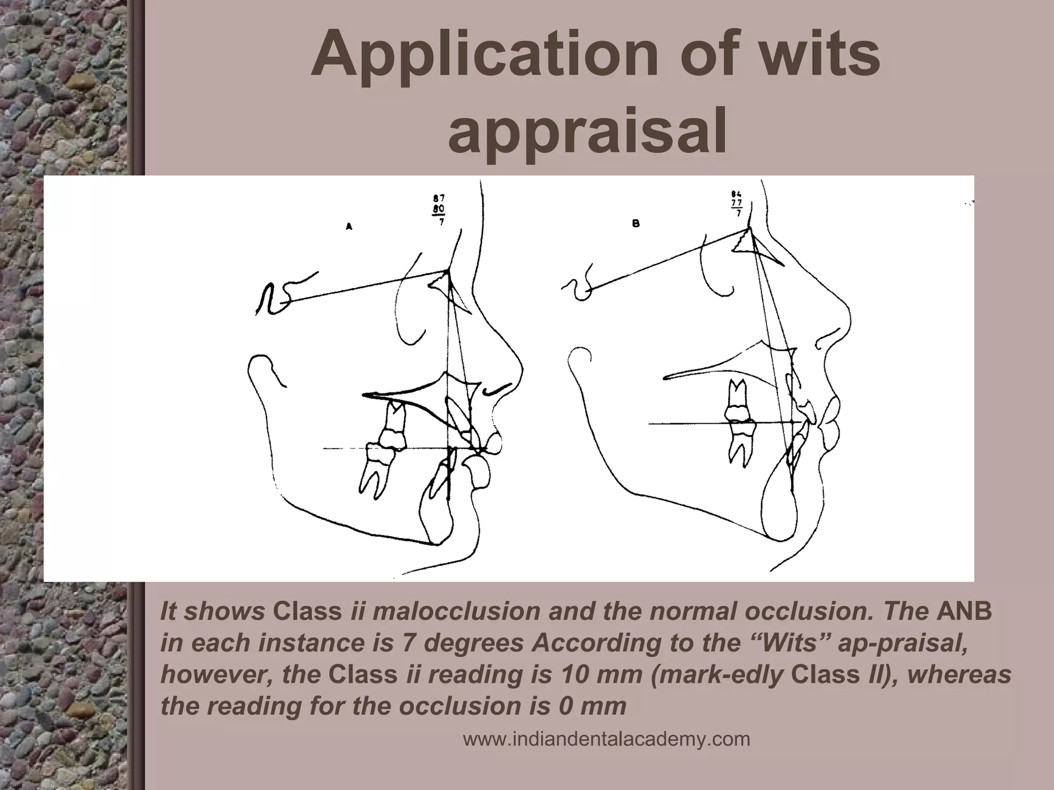 wits appraisal of jaw disharmony. | PPT