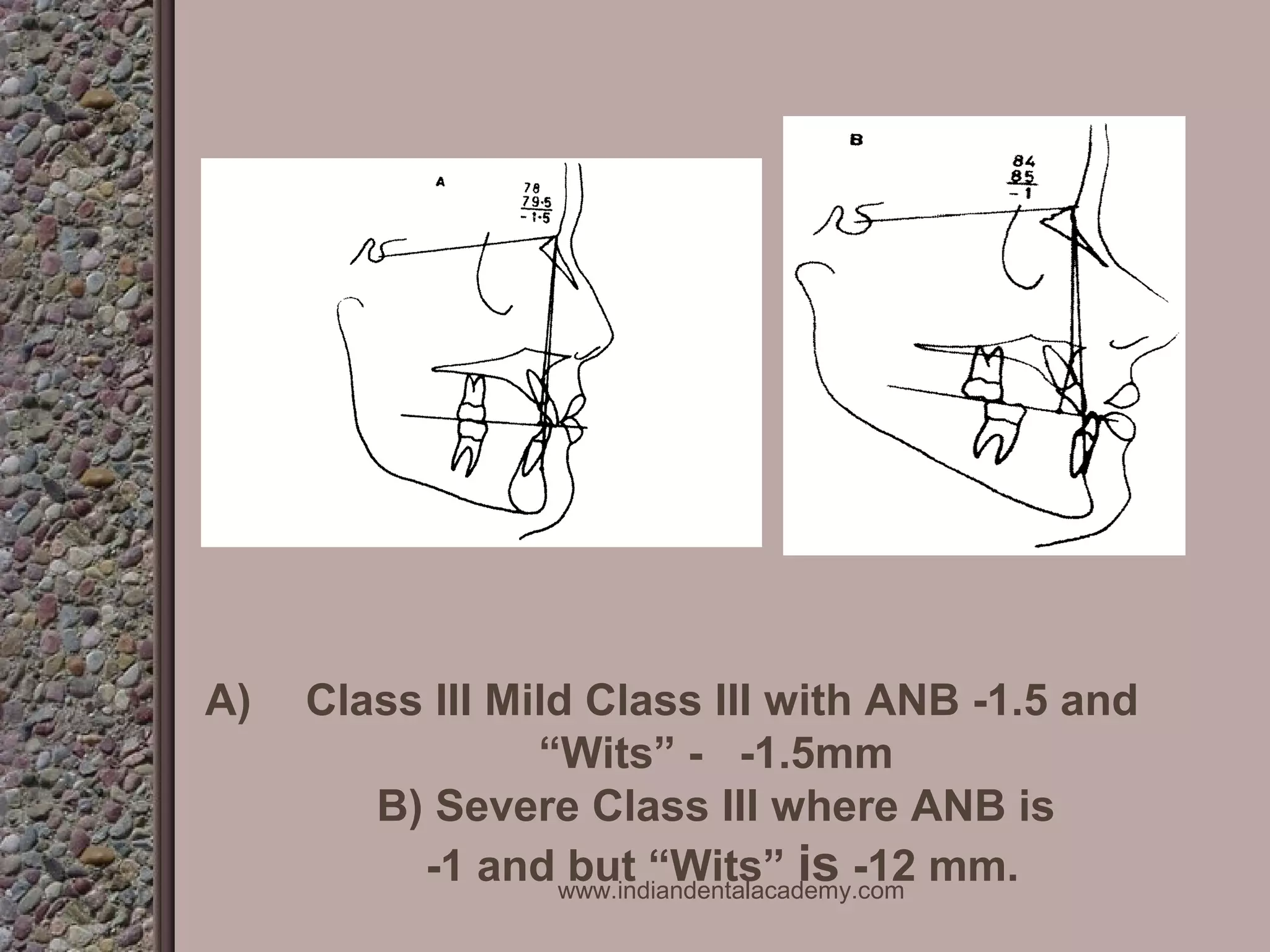 wits appraisal of jaw disharmony. | PPT
