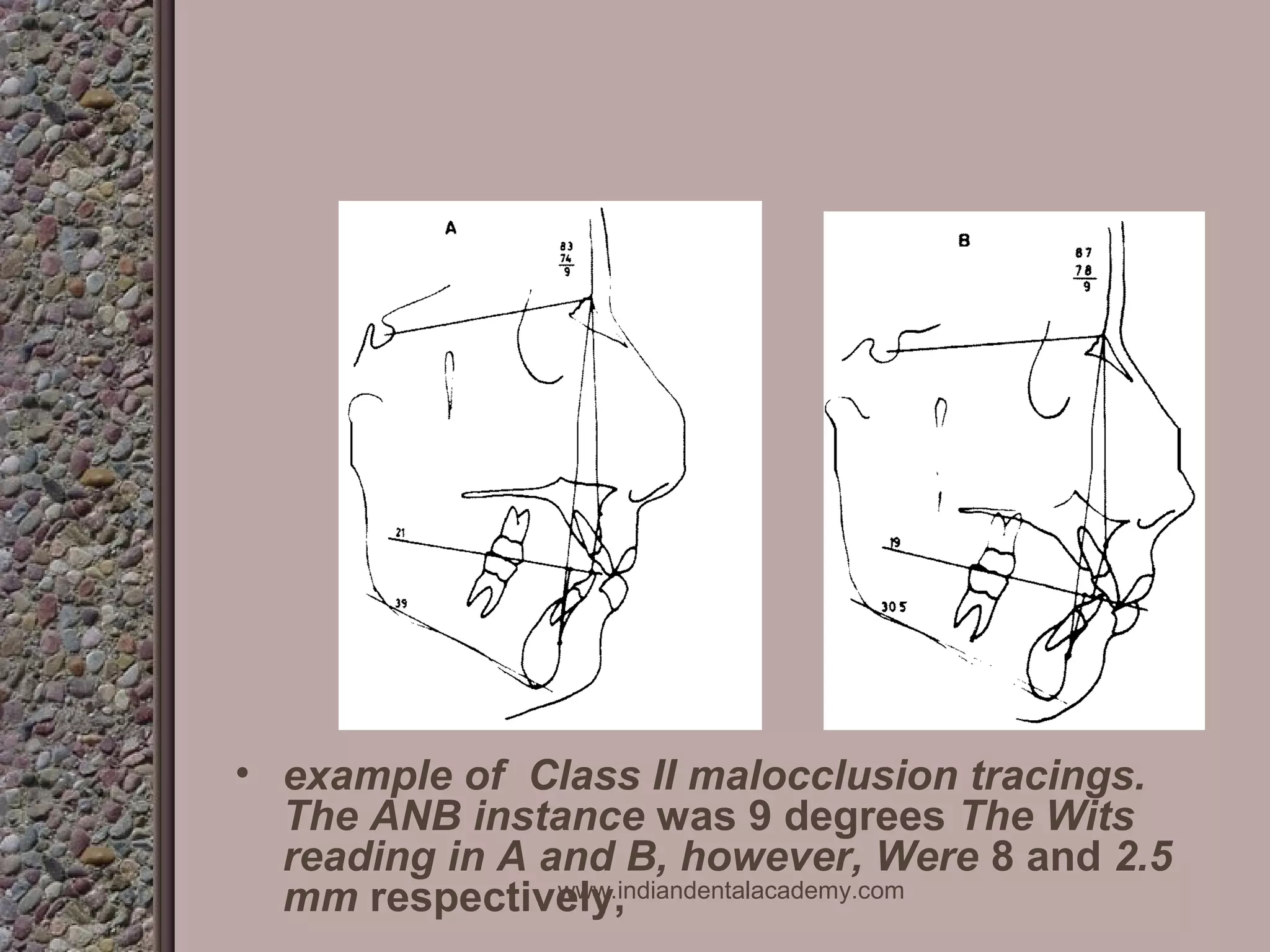 wits appraisal of jaw disharmony. | PPT
