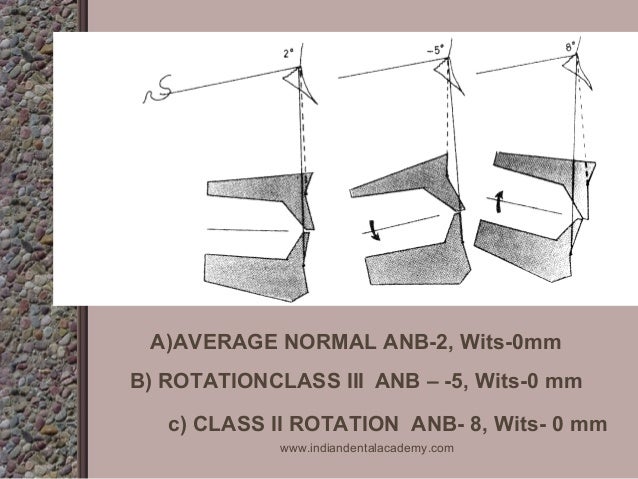 wits appraisal of jaw disharmony.