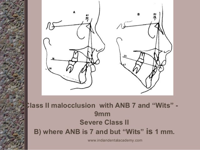 wits appraisal of jaw disharmony.