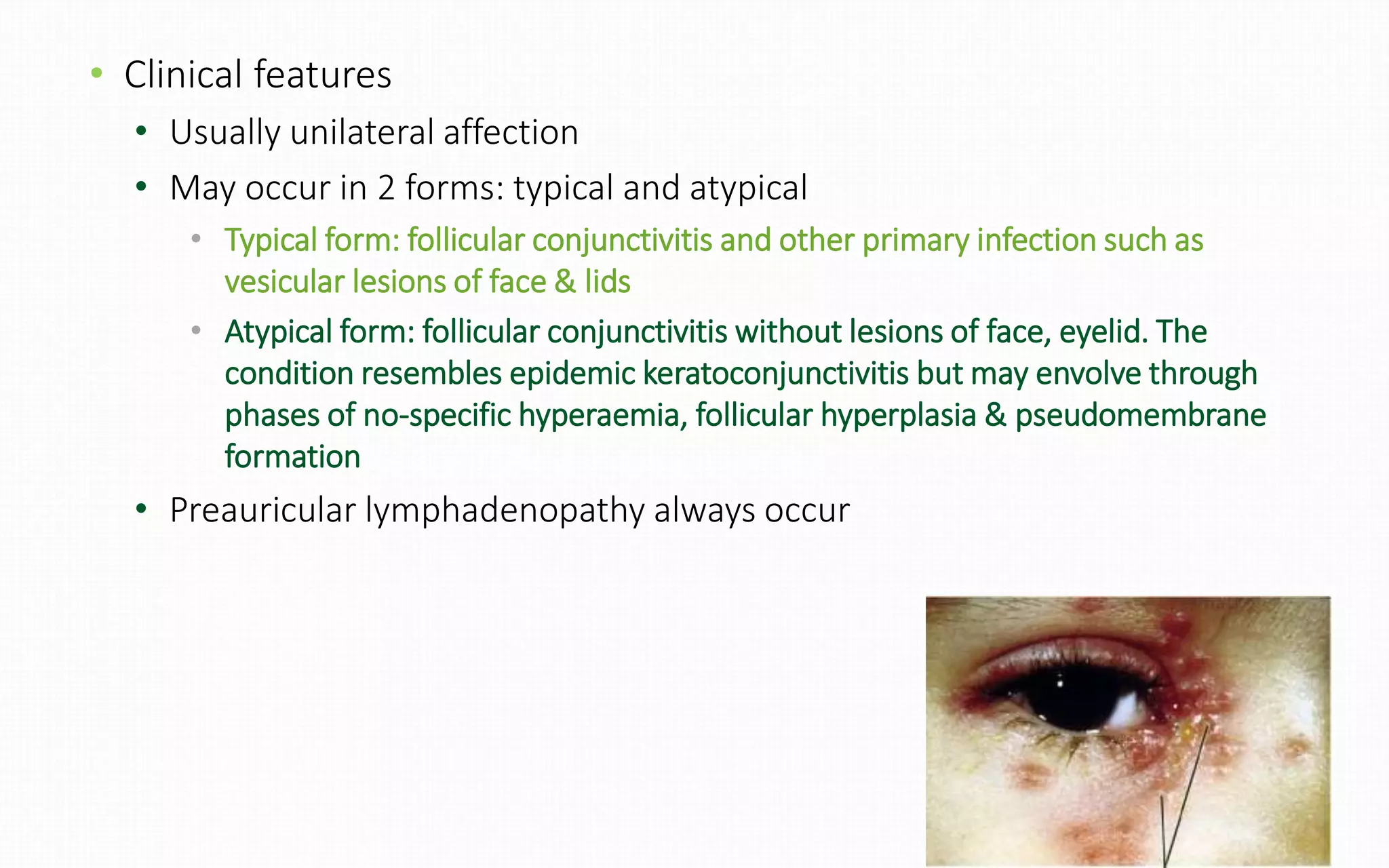 viral conjuctivitis | PPTX